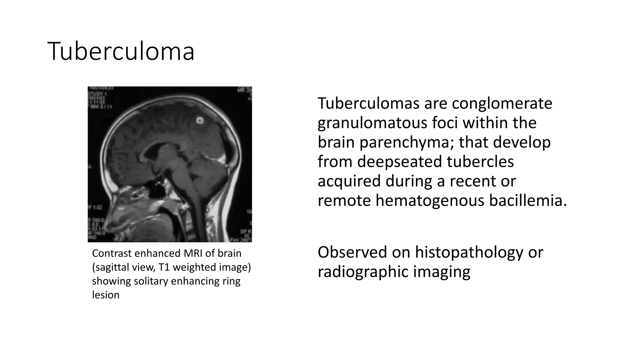 Extrapulmonary Tuberculosis_SRP.....pptx