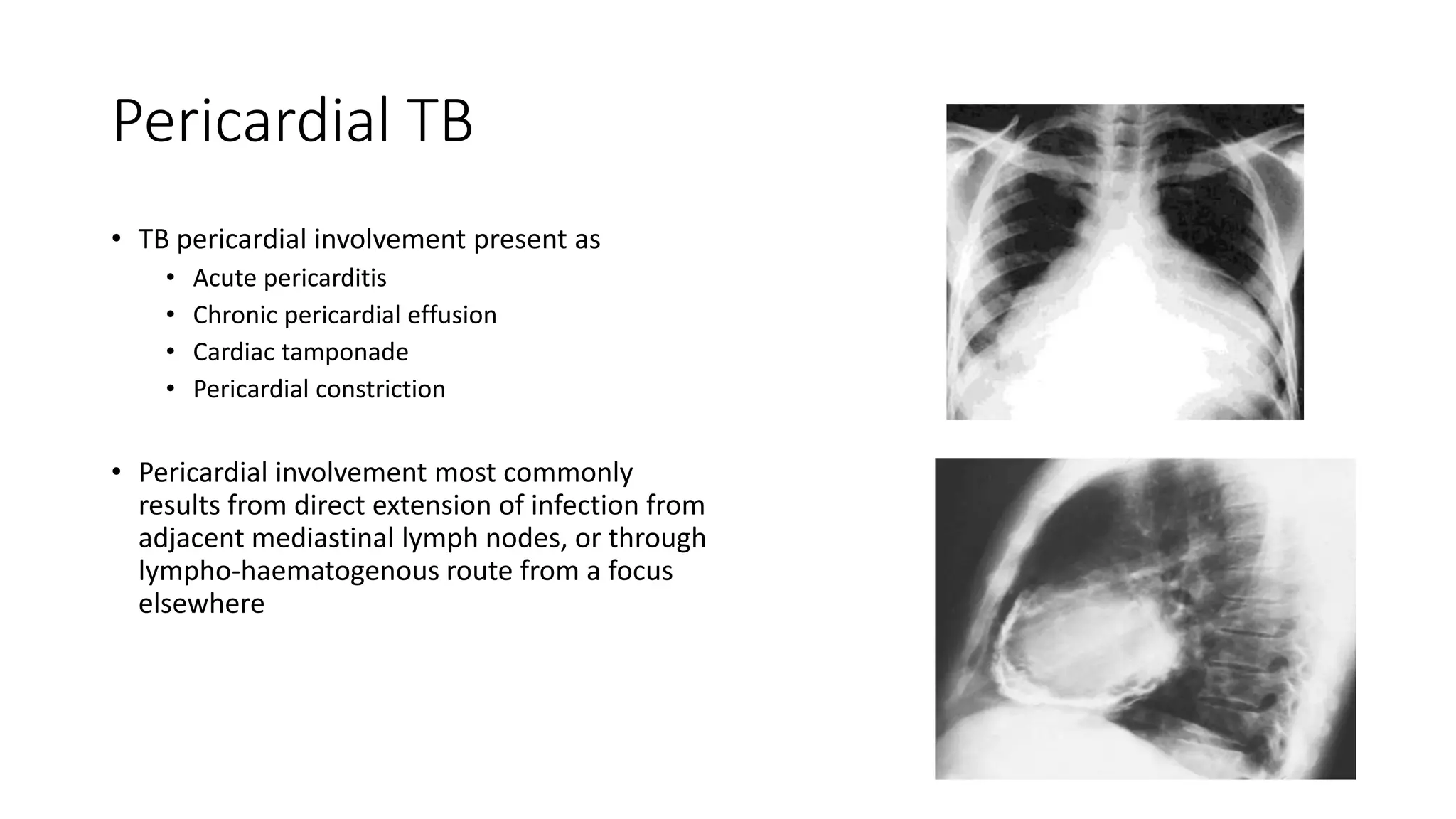 Extrapulmonary Tuberculosis_SRP.....pptx