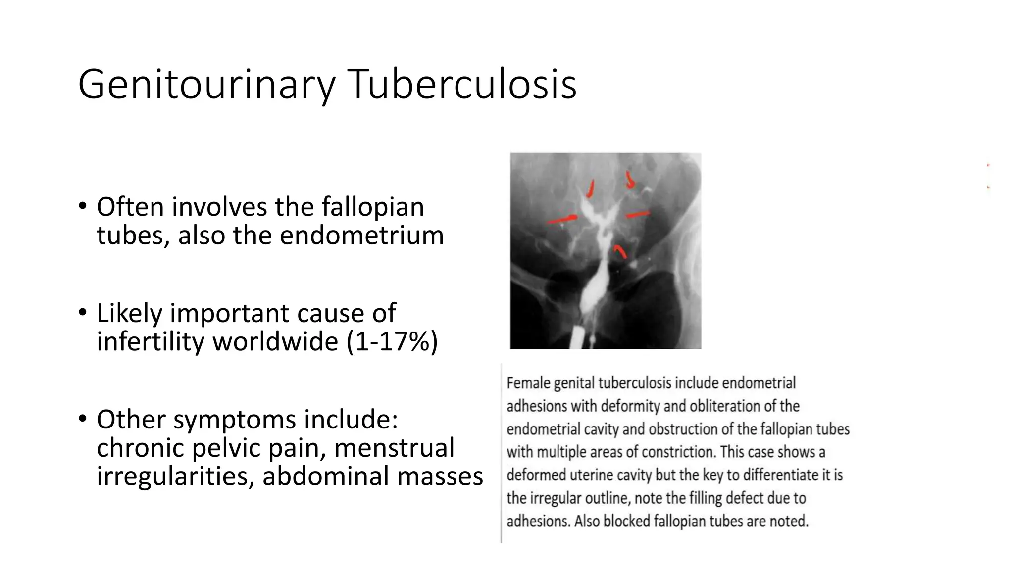 Extrapulmonary Tuberculosis_SRP.....pptx