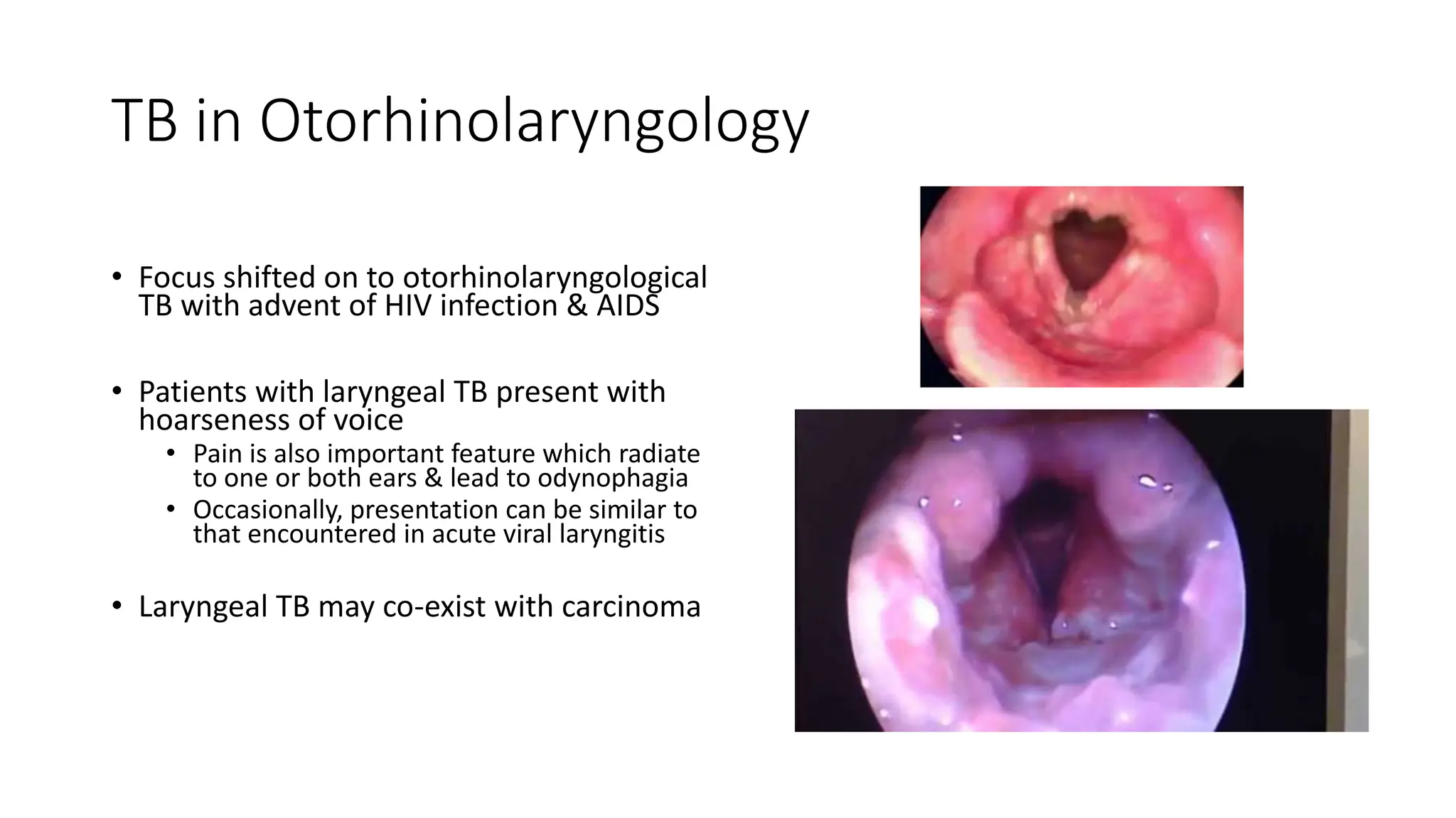 Extrapulmonary Tuberculosis_SRP.....pptx