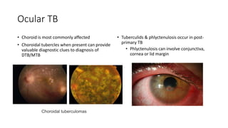 Extrapulmonary Tuberculosis_SRP.....pptx