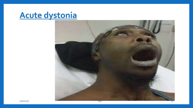 Extra pyramidal side effects | PPTX