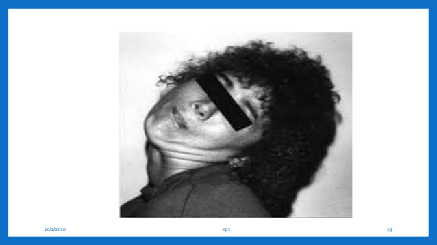 Extra pyramidal side effects | PPTX