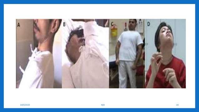 Extra pyramidal side effects | PPTX