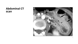 Extras for intussusception with barium .pptx