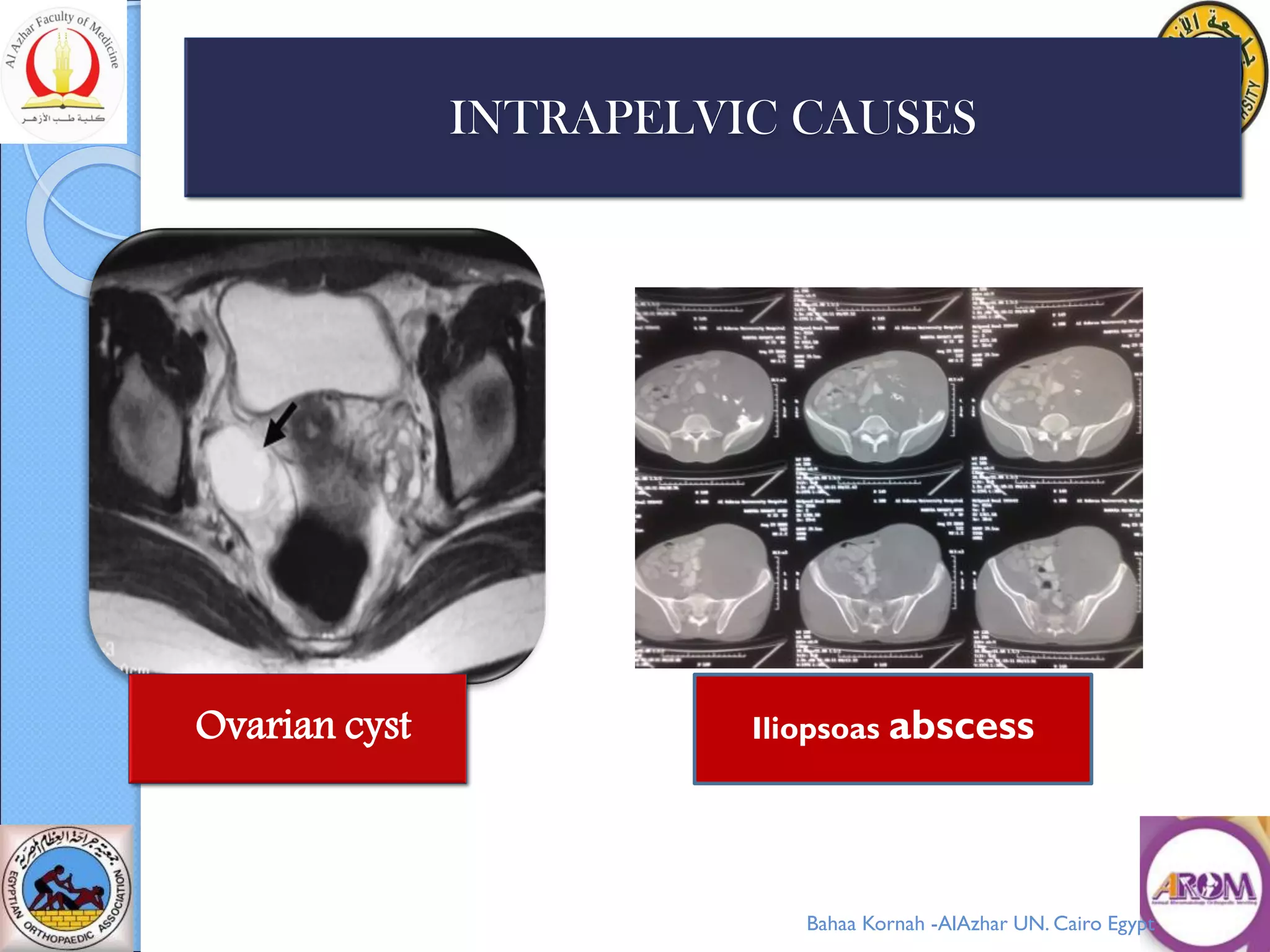 Extra Spinal Causes Of Sciatica And A Causes Algorithm Ppt 6966