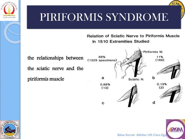 Extra Spinal Causes Of Sciatica And A Causes Algorithm Ppt 9332