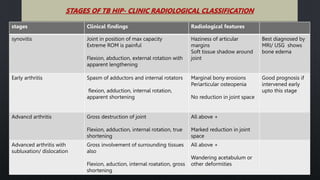 extra spinal tb ug.pptx