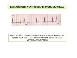 EXTRASÍSTOLES.pptx
