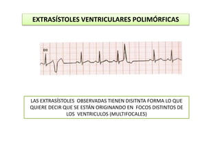 EXTRASÍSTOLES.pptx