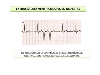 EXTRASÍSTOLES.pptx