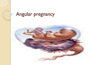 EXTRA UTERINE OR ECTOPIC PRENANCY | PDF