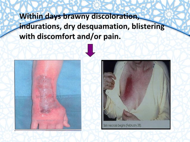 Extravasation | PPT | First Aid | Injuries