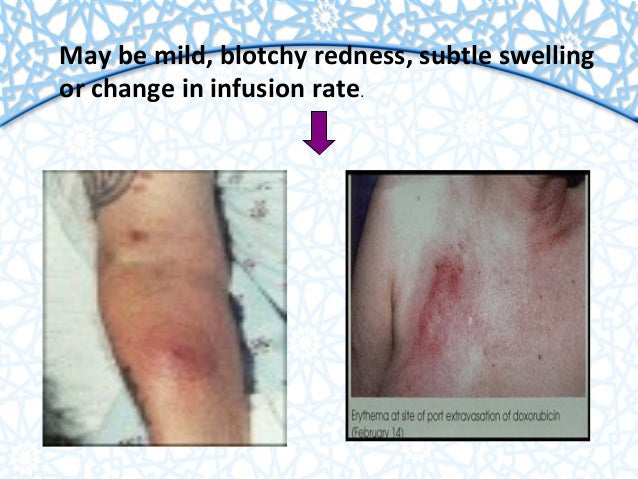 Iv Infiltration Blanching