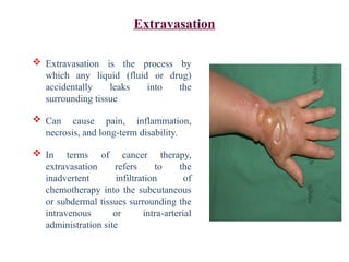 Extravasation Injury (1).pptx extravasation of chemo drugs | PPTX