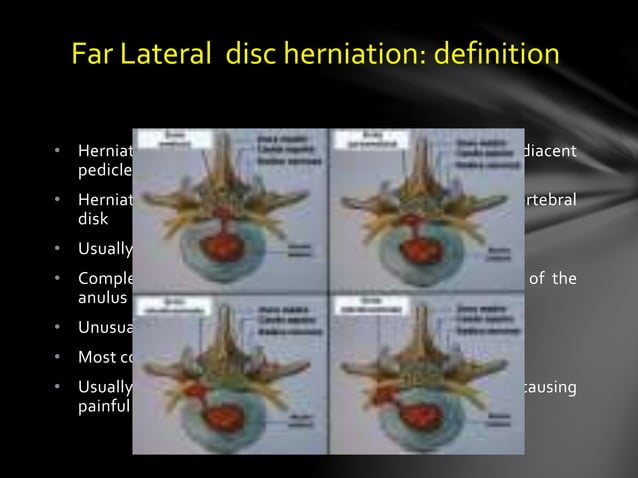 Extreme Lateral Disc Herniation Causing Lumbar And Radicular Pain | PPT