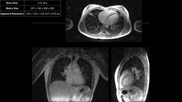 Extreme MRI: Super-High-Res Dynamic Volumetric MRI from Continuous Non ...