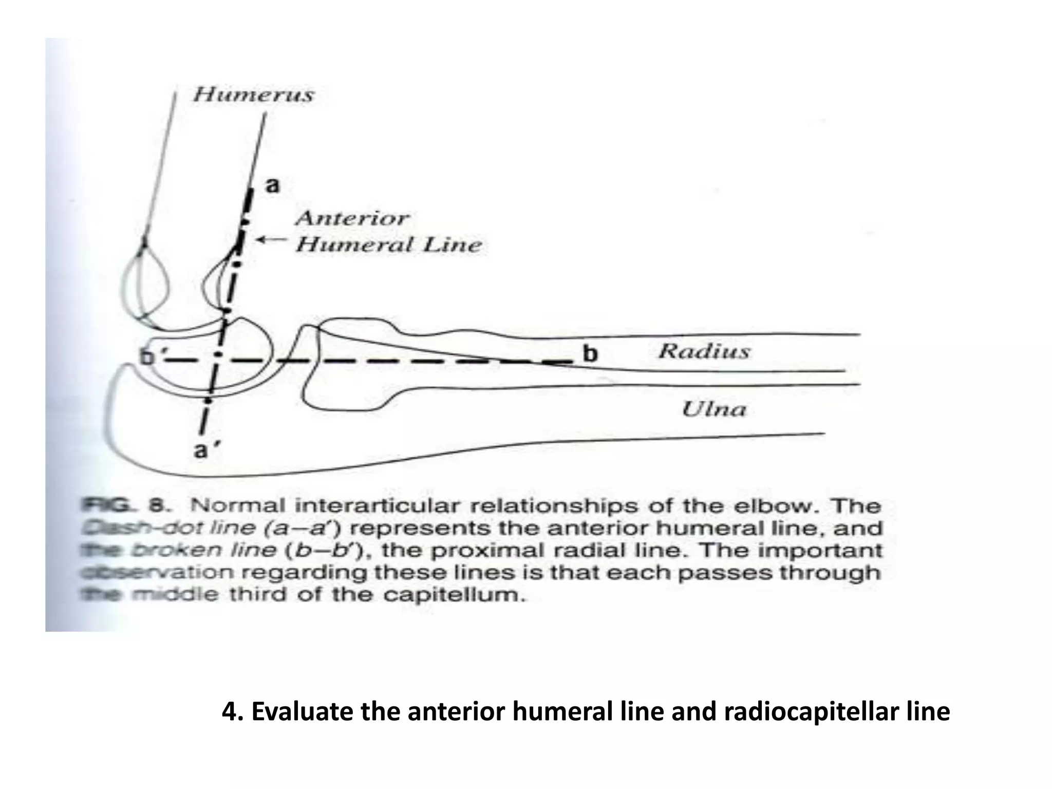 Extremity trauma | PPTX