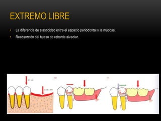 Extremo libre en PPR | PPTX