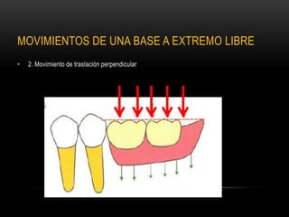 Extremo libre en PPR | PPTX