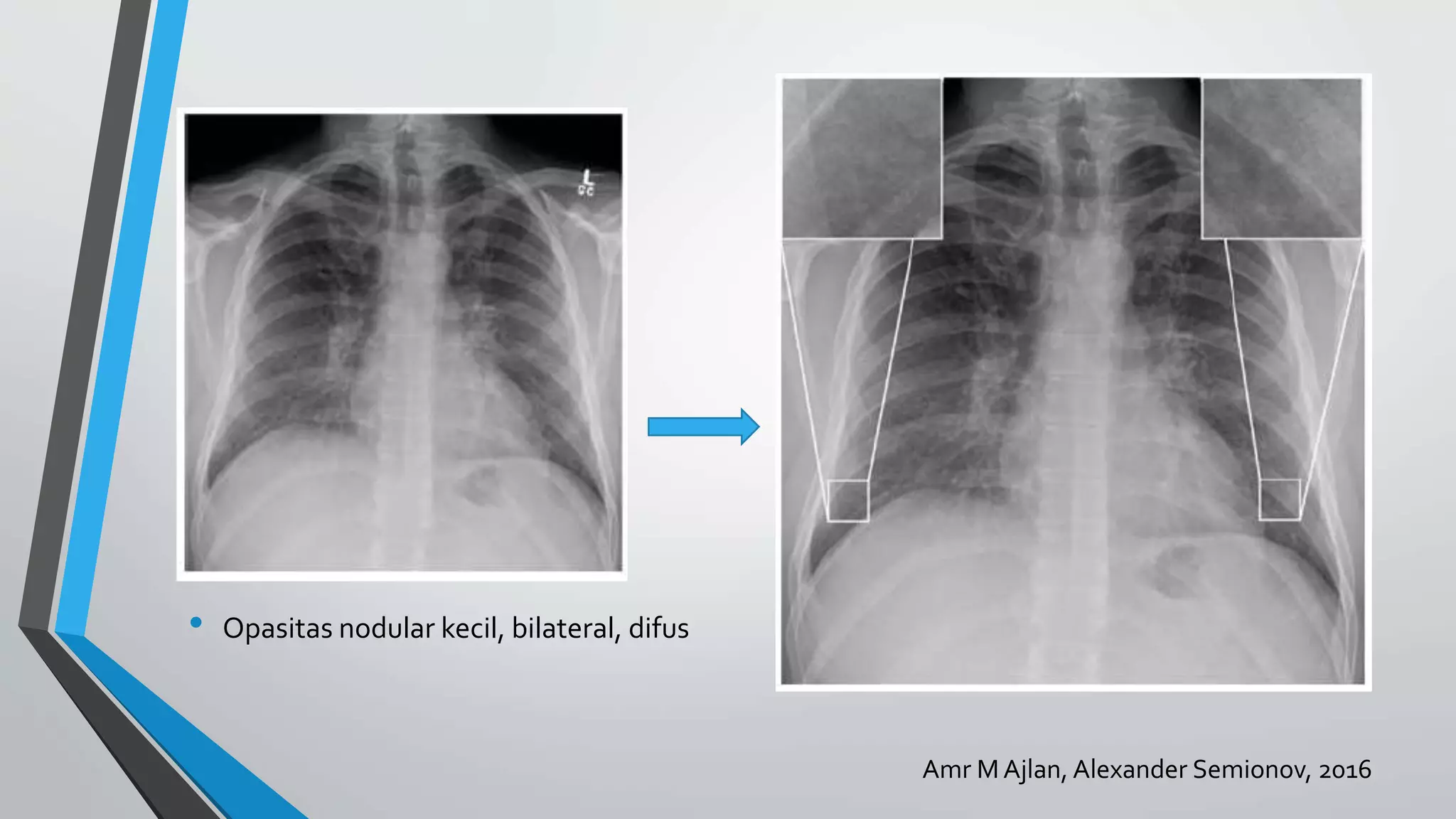 Extrinsic allergic alveolitis | PPTX