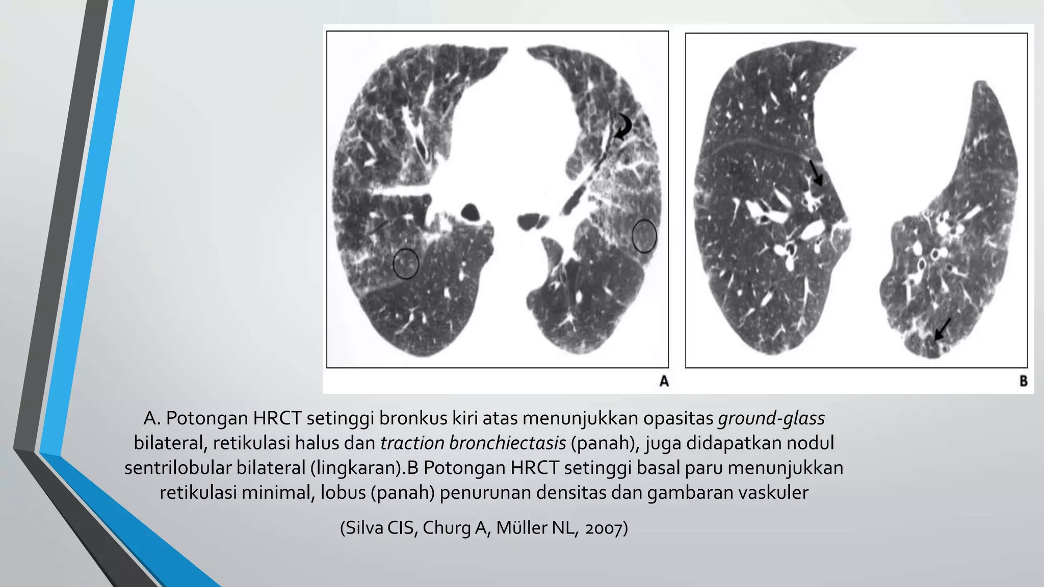 Extrinsic allergic alveolitis | PPTX