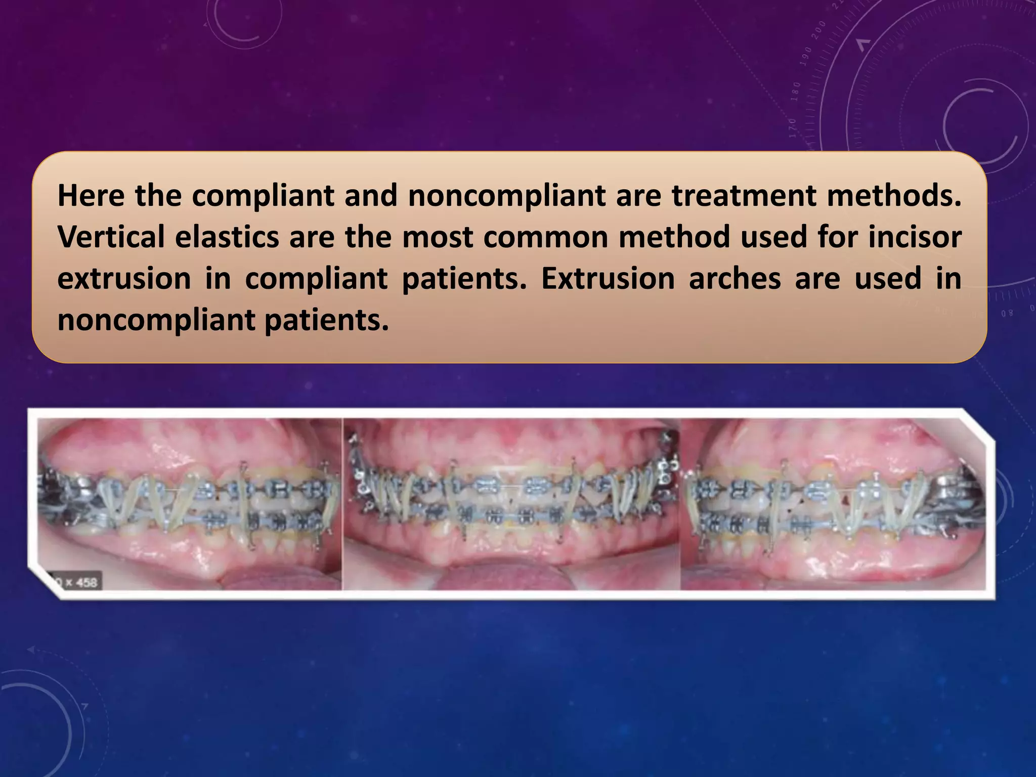 Extrusion arches of Nanda by Dr Maher Fouda | PPTX