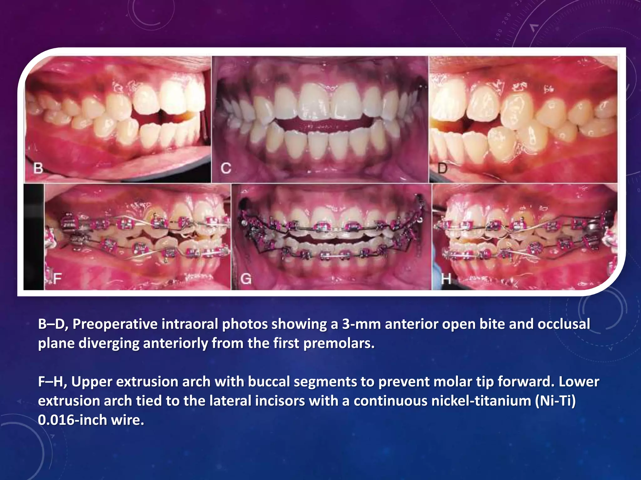 Extrusion arches of Nanda by Dr Maher Fouda | PPTX