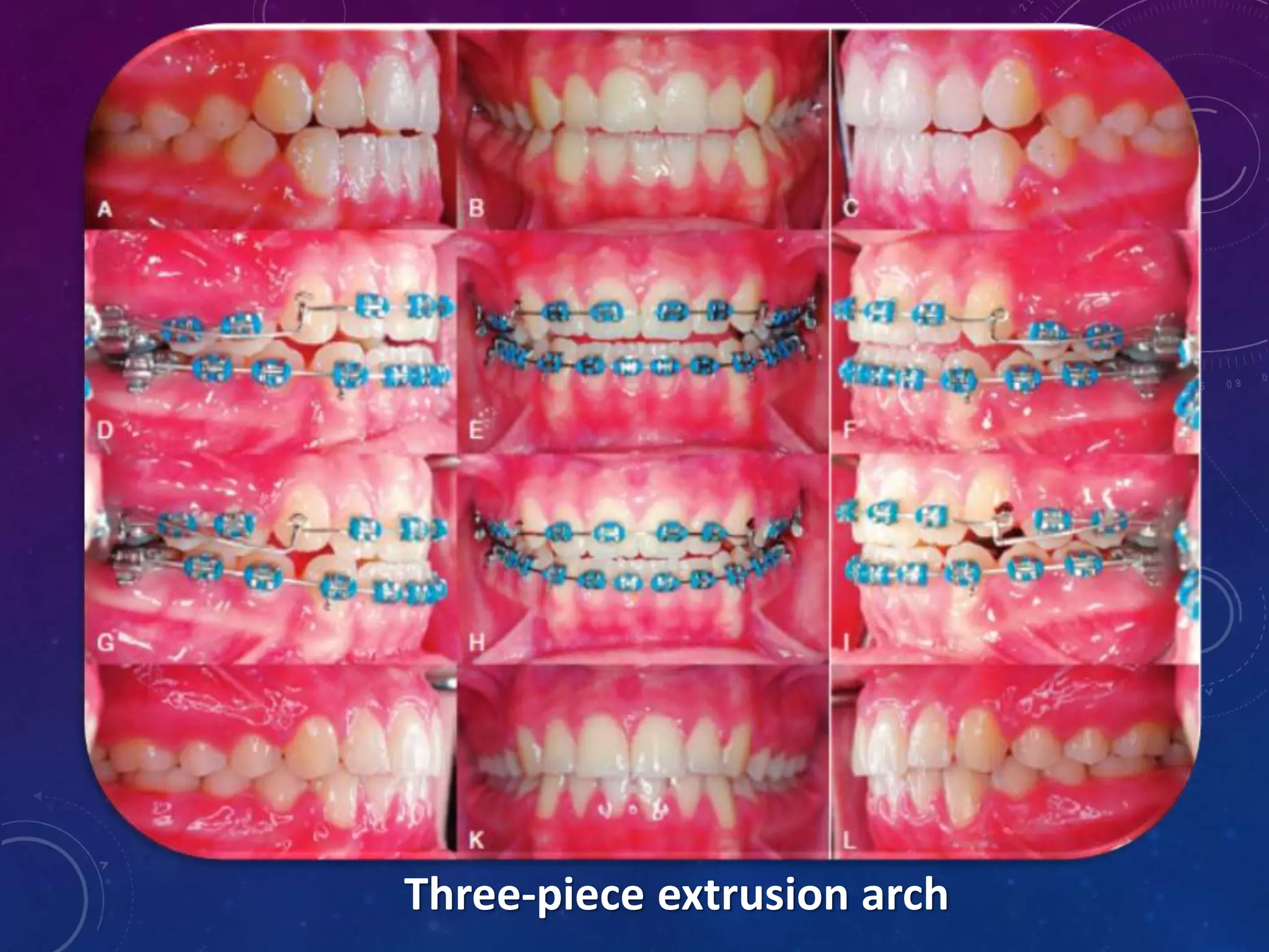Extrusion arches of Nanda by Dr Maher Fouda | PPTX