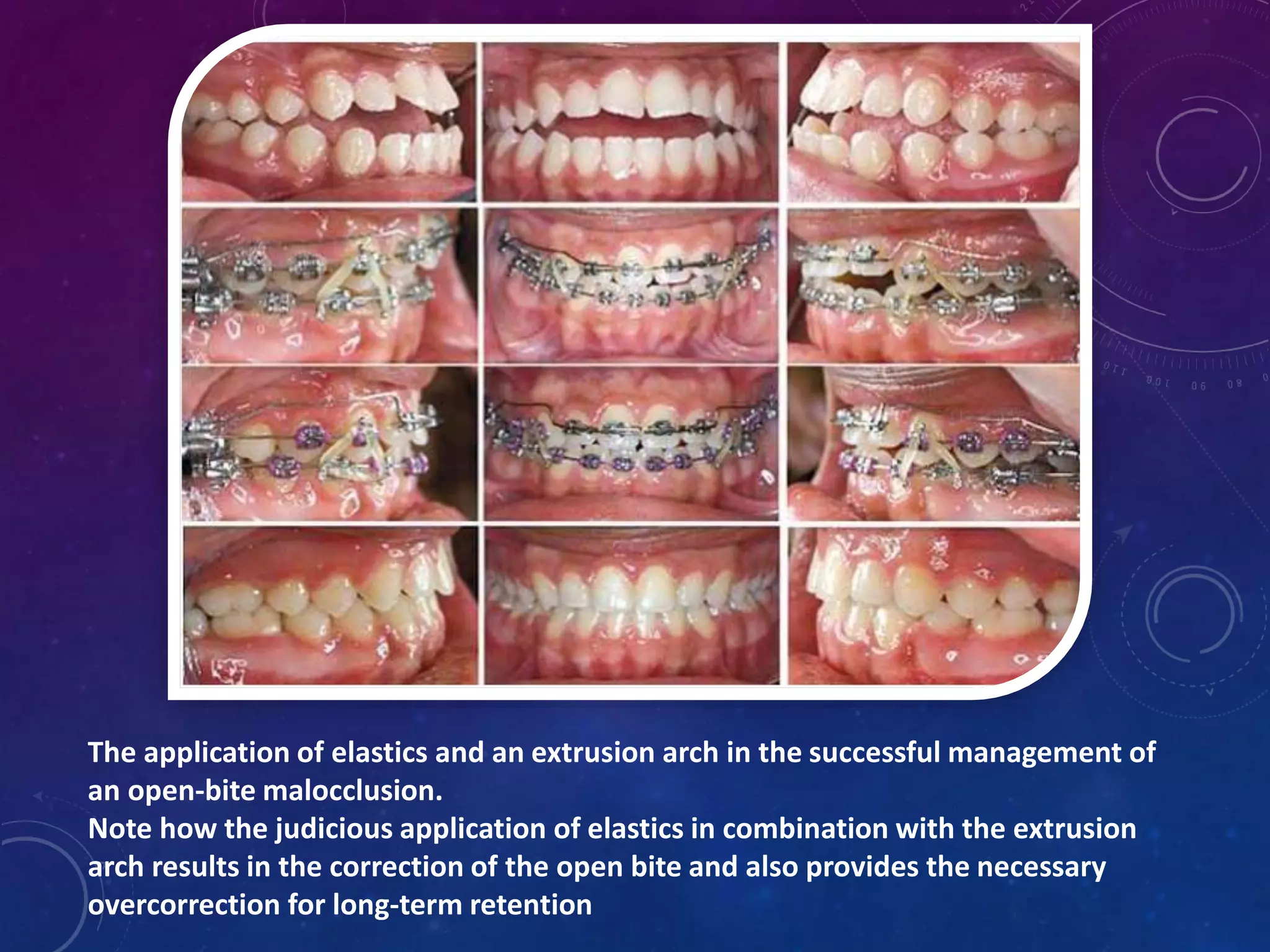 Extrusion arches of Nanda by Dr Maher Fouda | PPTX