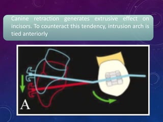 Extrusion arches of Nanda by Dr Maher Fouda | PPTX
