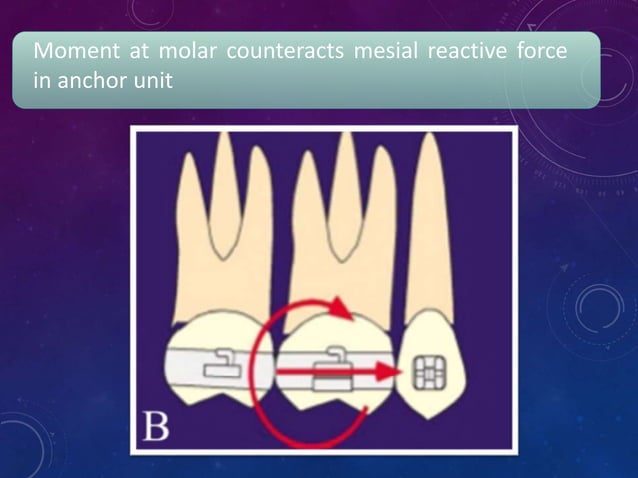 Extrusion arches of Nanda by Dr Maher Fouda | PPTX | Dental Health ...