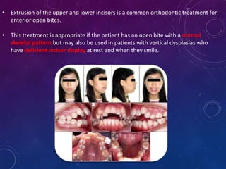 Extrusion arches of Nanda by Dr Maher Fouda | PPTX
