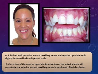 Extrusion arches of Nanda by Dr Maher Fouda | PPTX