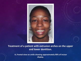 Extrusion arches of Nanda by Dr Maher Fouda | PPTX