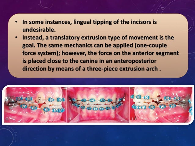 Extrusion arches of Nanda by Dr Maher Fouda | PPTX | Dental Health ...