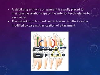 Extrusion arches of Nanda by Dr Maher Fouda | PPTX