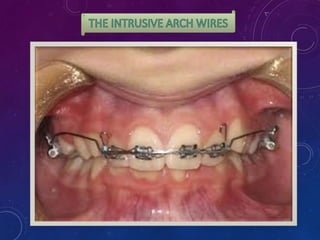 Extrusion arches of Nanda by Dr Maher Fouda | PPTX