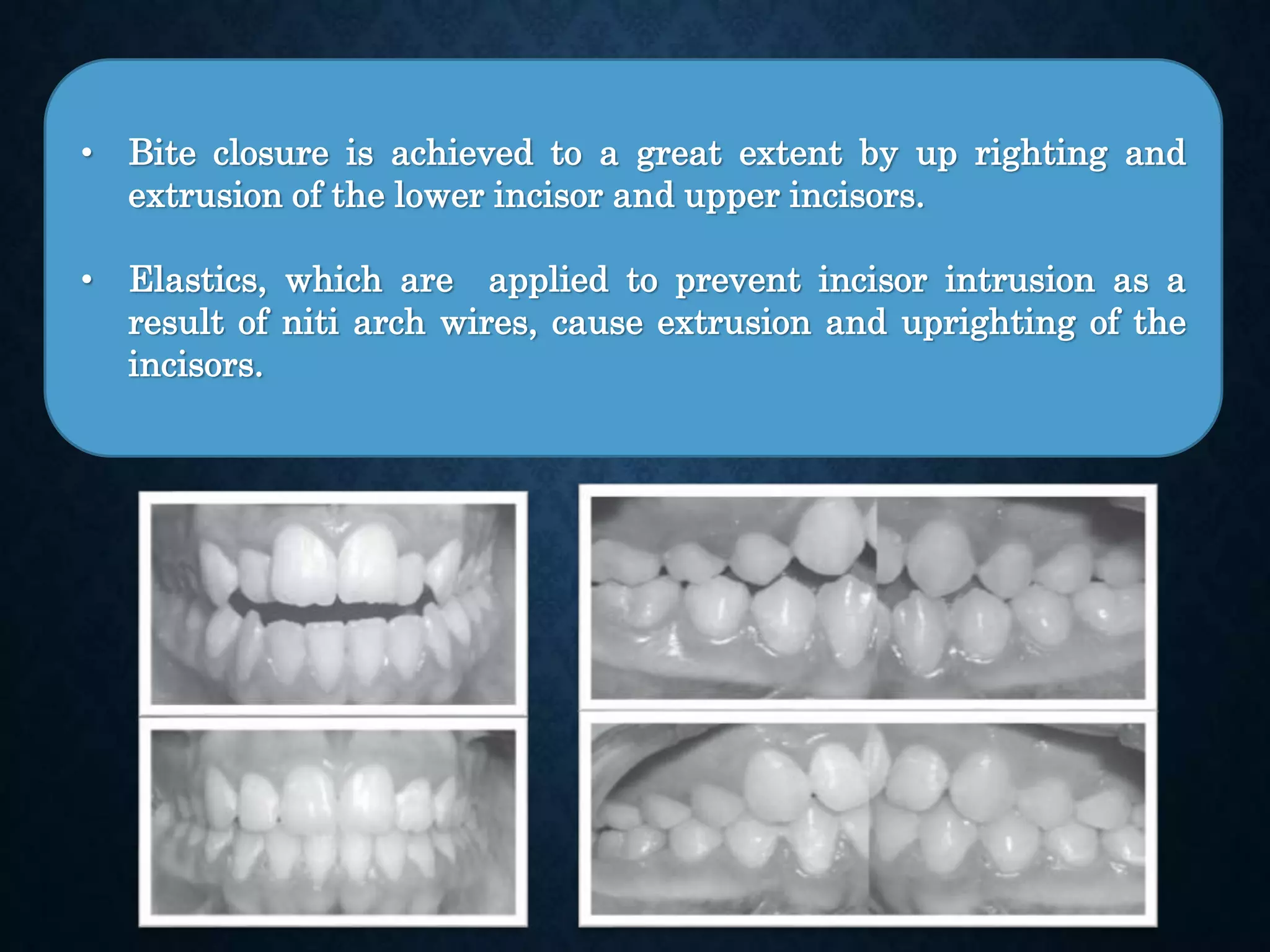 Extrusion by reverse curves archwires by Dr Maher Fouda | PPTX