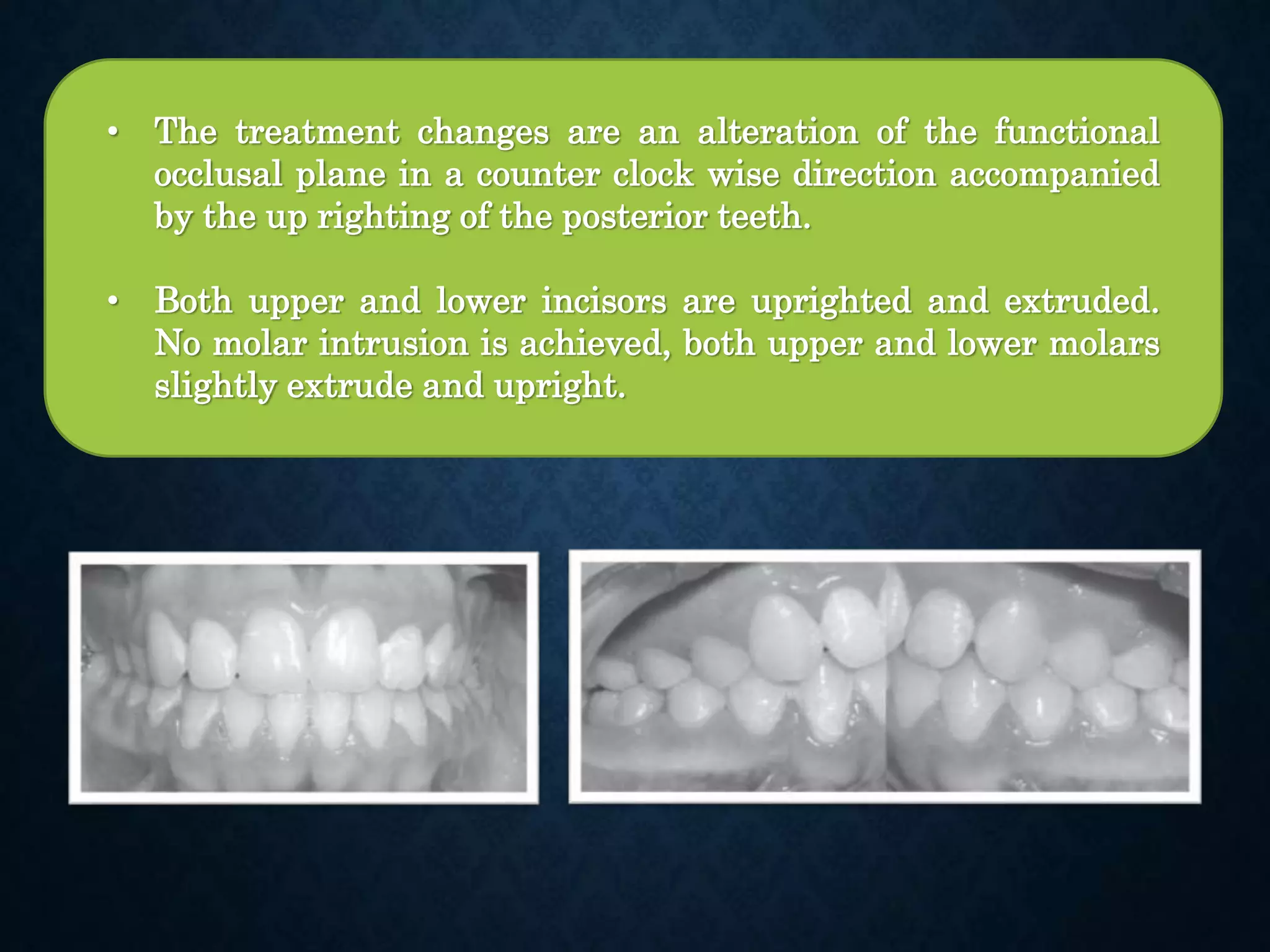 Extrusion by reverse curves archwires by Dr Maher Fouda | PPTX