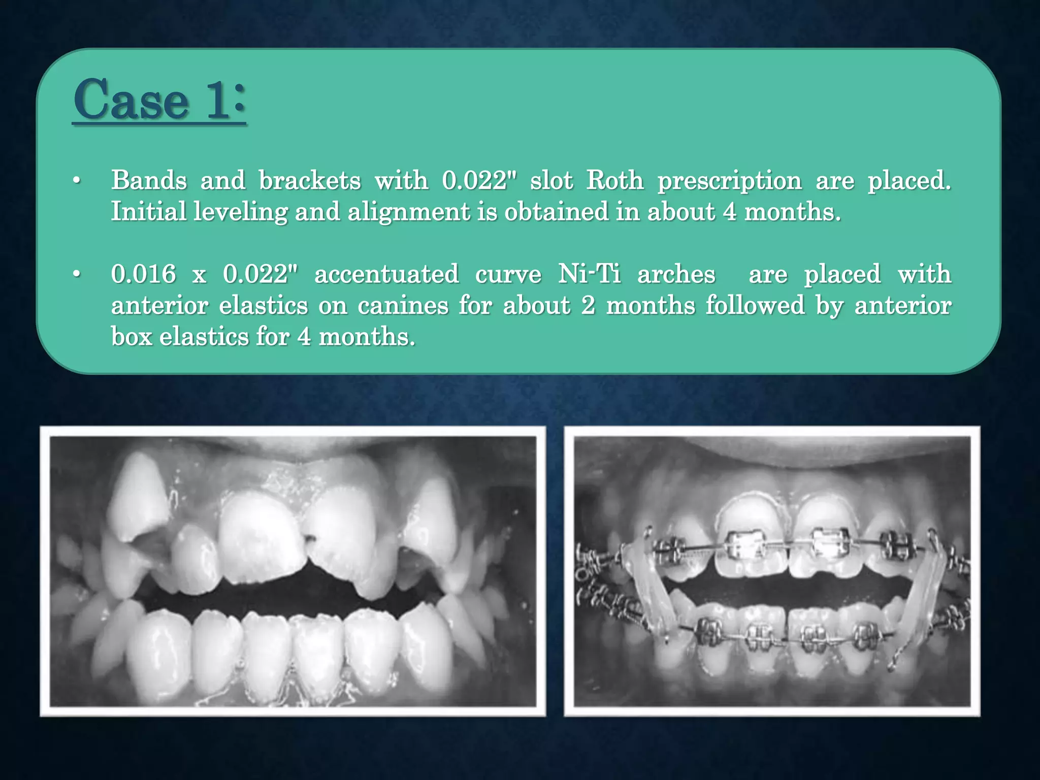 Extrusion by reverse curves archwires by Dr Maher Fouda | PPTX