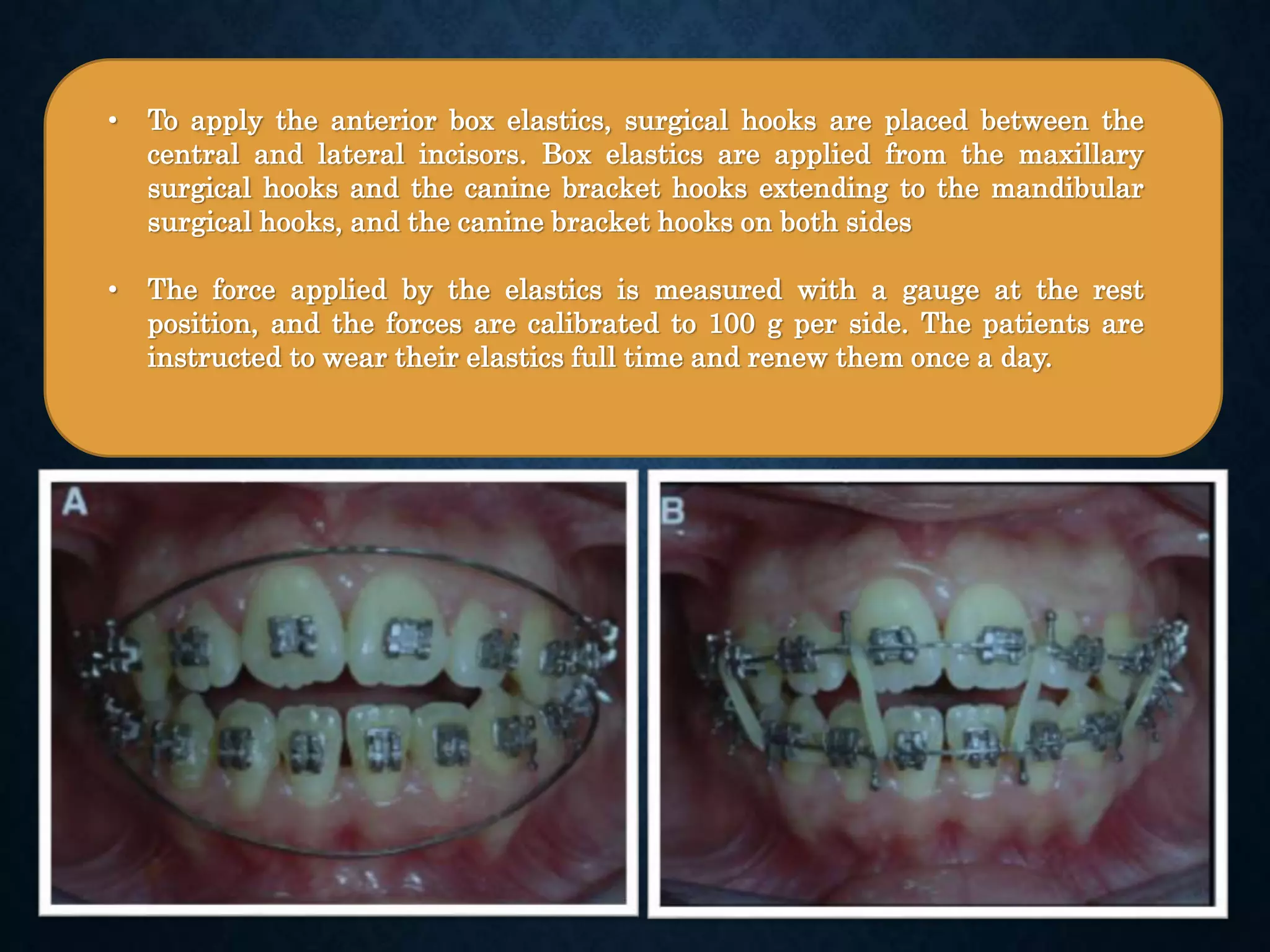 Extrusion by reverse curves archwires by Dr Maher Fouda | PPTX