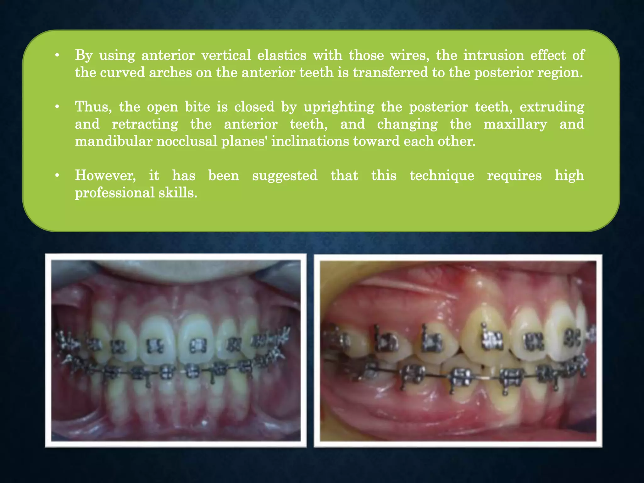 Extrusion by reverse curves archwires by Dr Maher Fouda | PPTX
