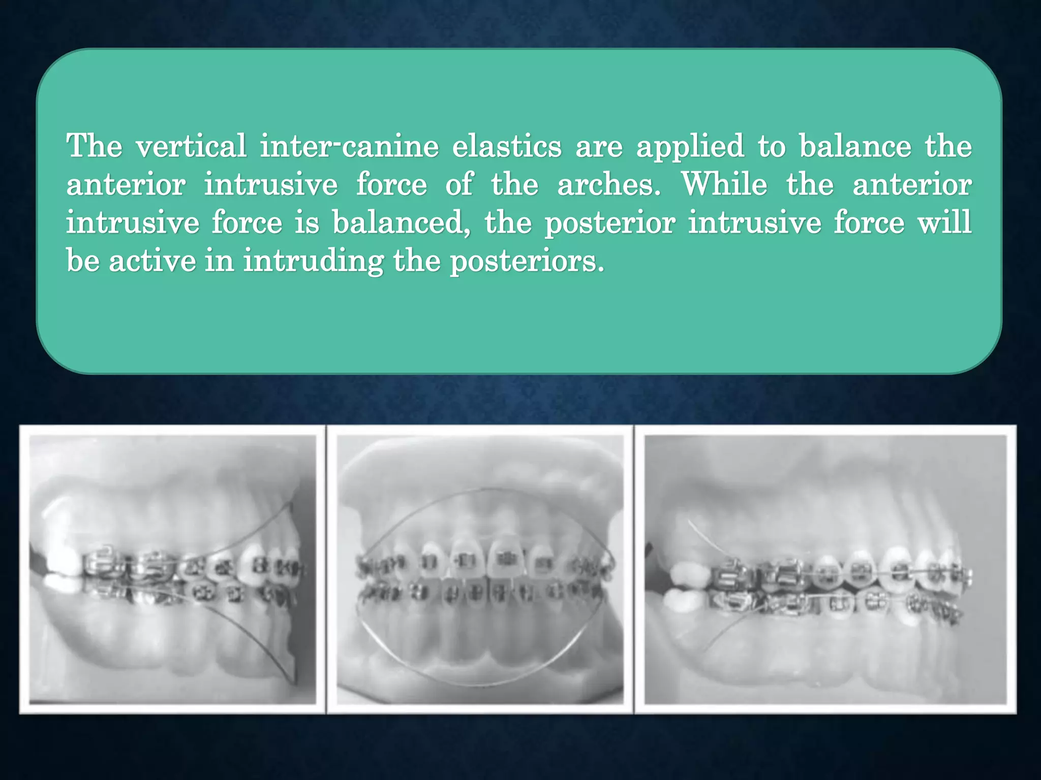 Extrusion by reverse curves archwires by Dr Maher Fouda | PPTX