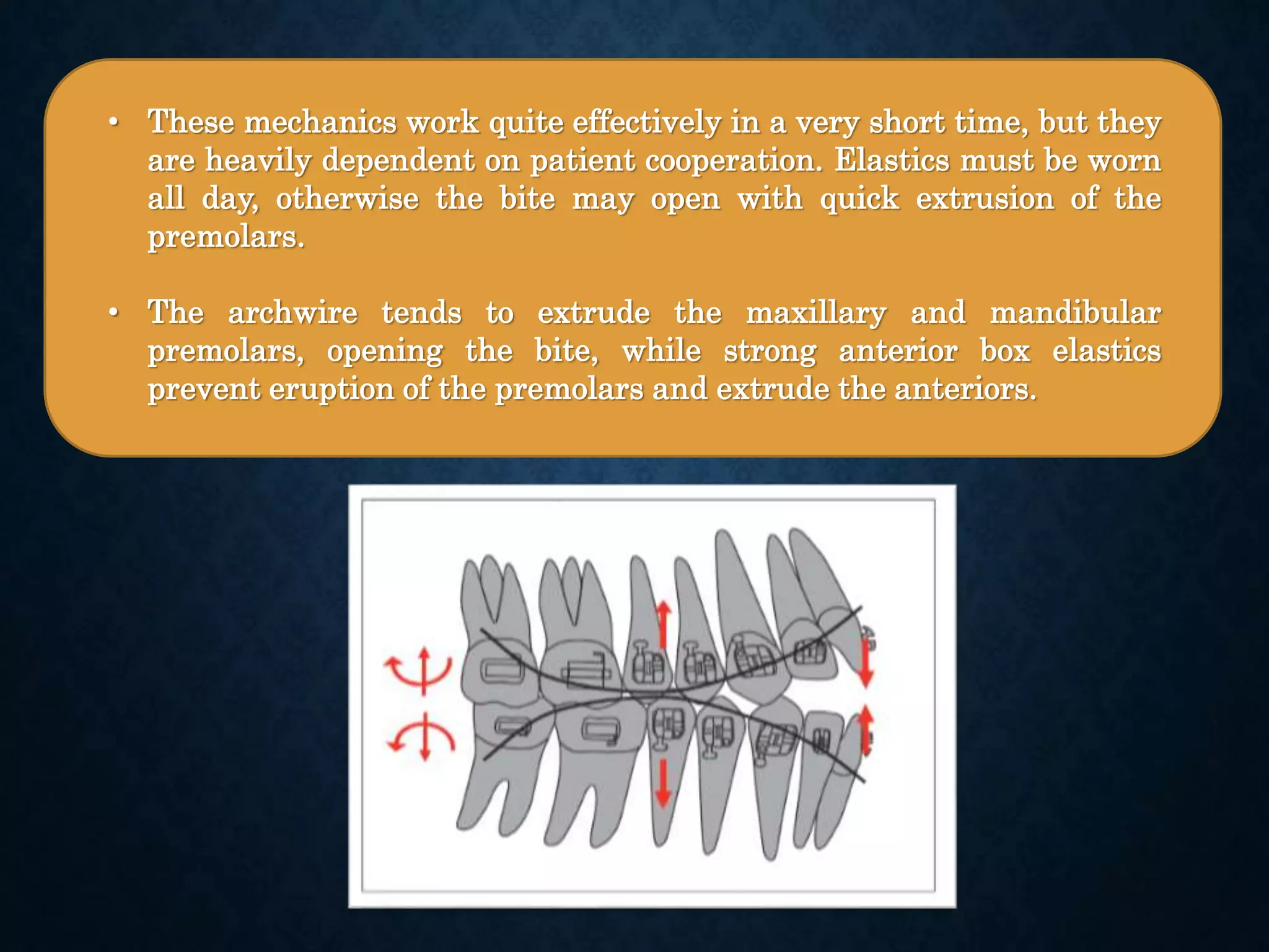 Extrusion by reverse curves archwires by Dr Maher Fouda | PPTX
