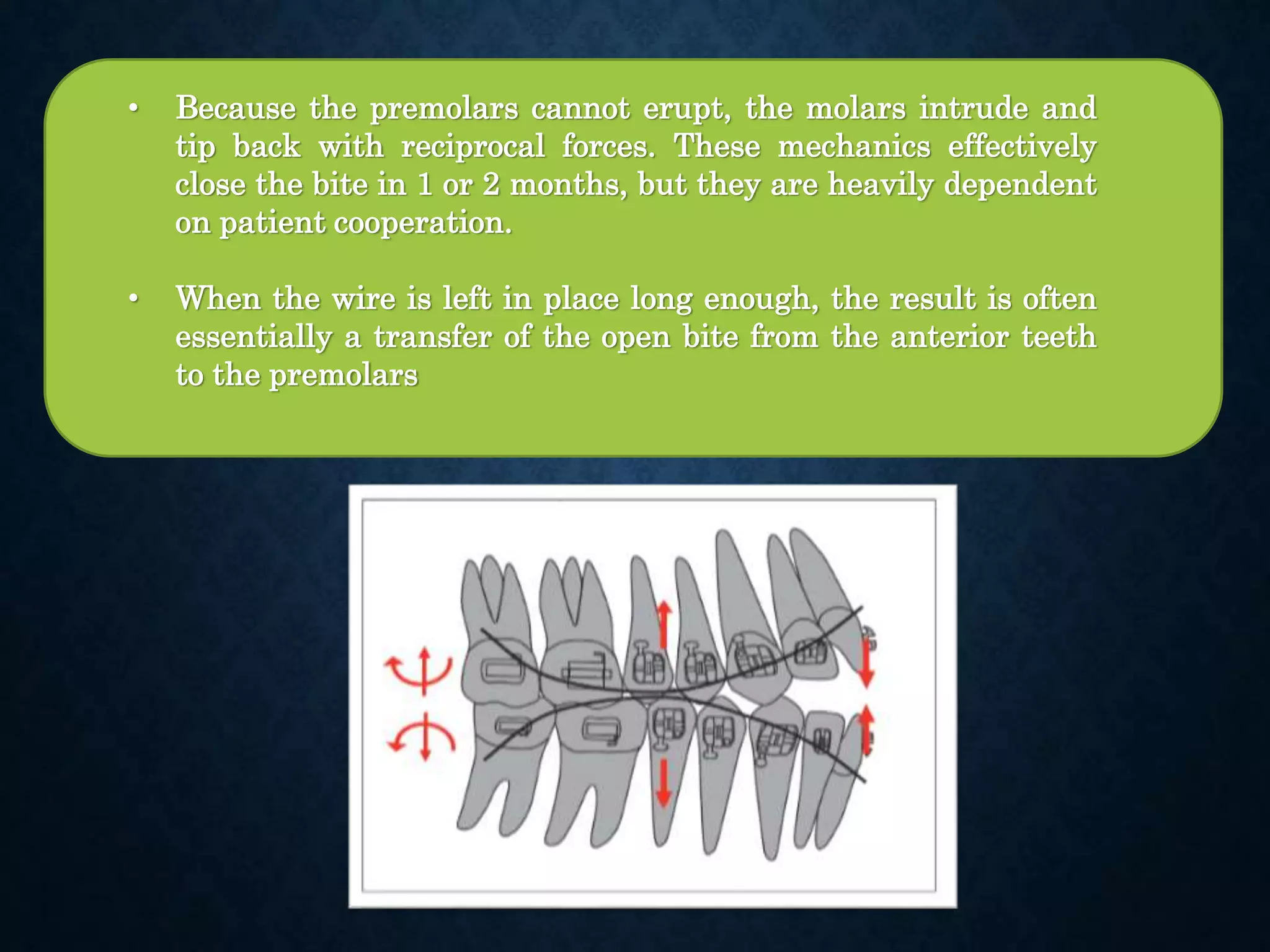 Extrusion by reverse curves archwires by Dr Maher Fouda | PPTX