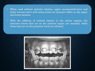 Extrusion by reverse curves archwires by Dr Maher Fouda | PPTX