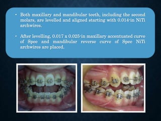 Extrusion by reverse curves archwires by Dr Maher Fouda | PPTX