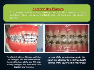 Extrusion by reverse curves archwires by Dr Maher Fouda | PPTX