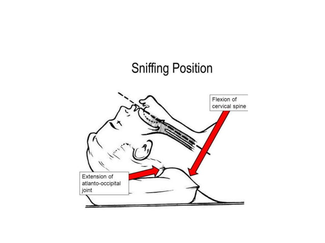 Extubation and reintubation | PPTX | Lung and Respiratory Health ...